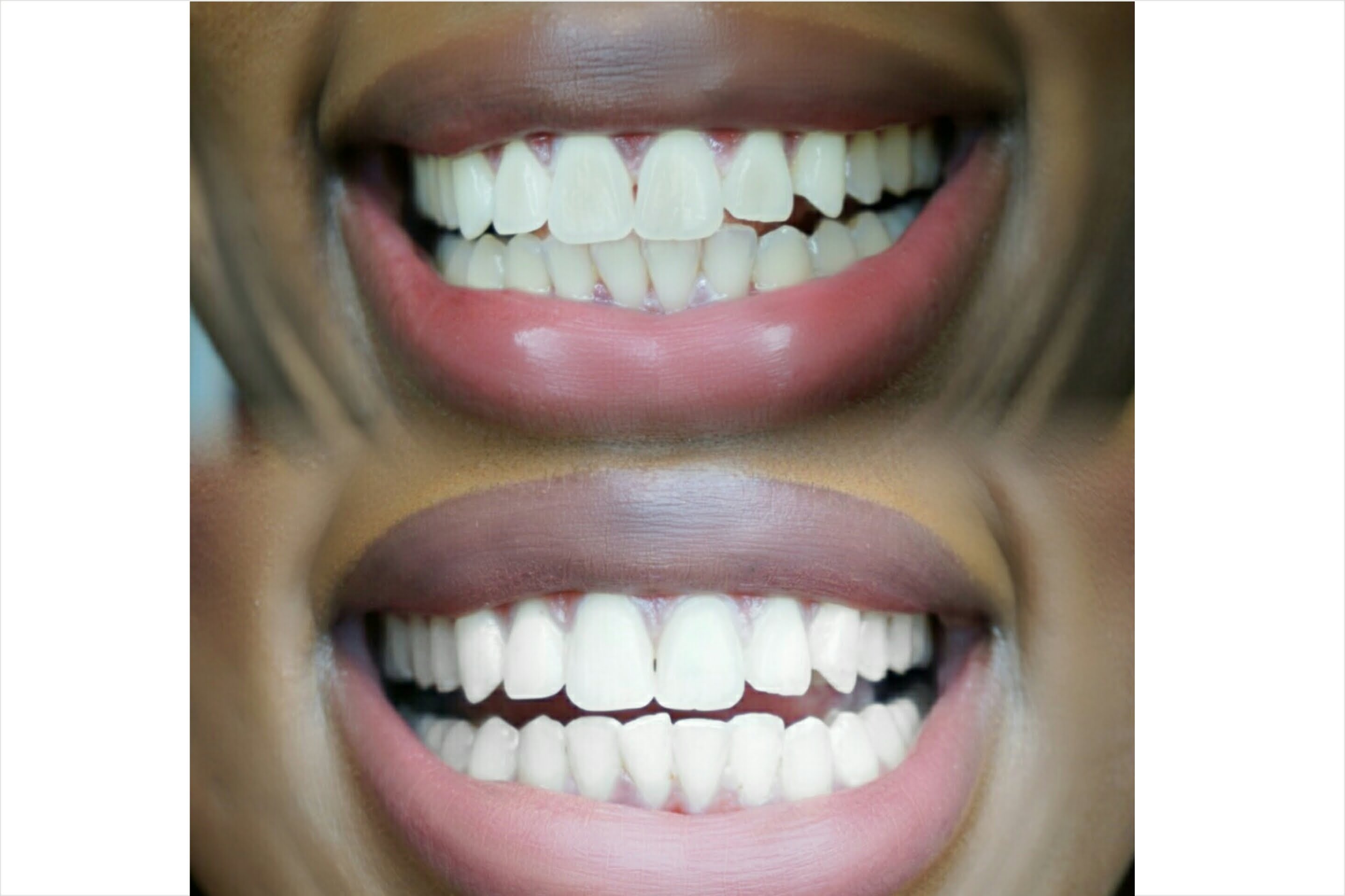 Bentonite Clay For Teeth Whitening | FabWoman