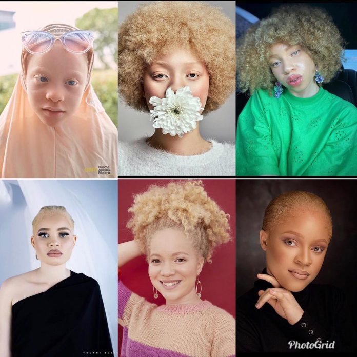Albinism In Women: Facts | Causes | Treatment | Fabwoman
