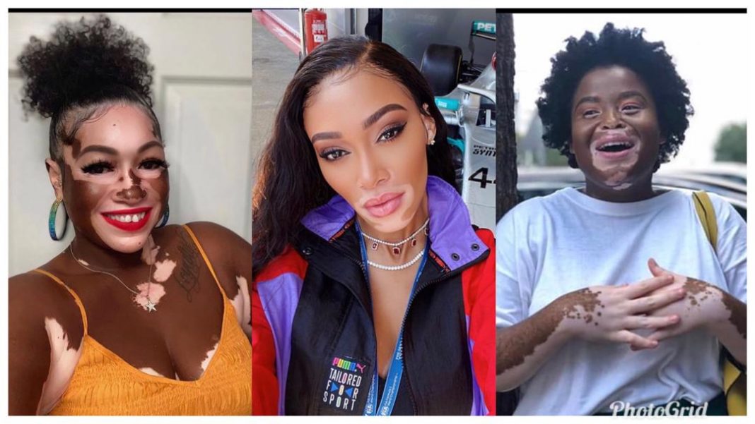 Vitiligo Skin: Causes | Symptoms | Treatment | FabWoman